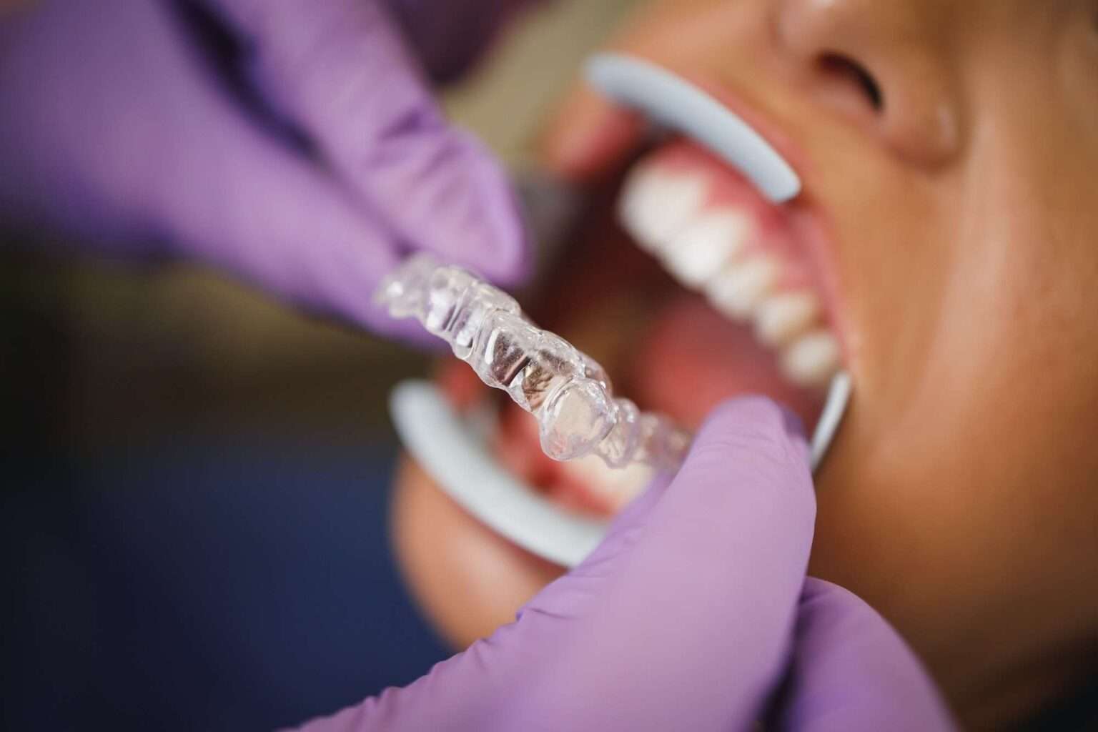 Invisalign - SDOC