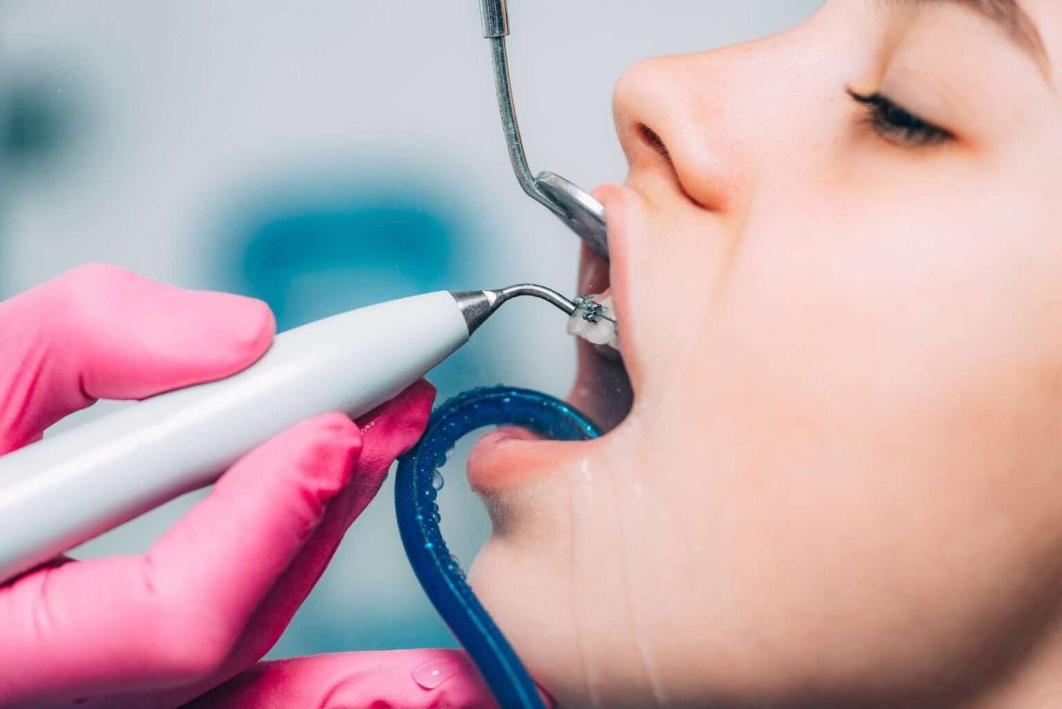 Dental Cleaning - SDOC